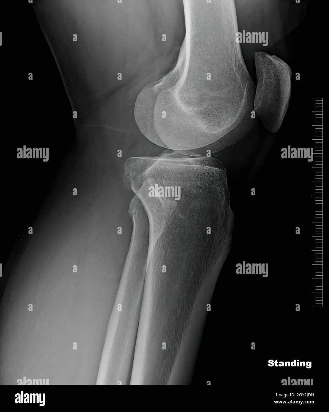 X-ray film of healthy male knees Stock Photo - Alamy
