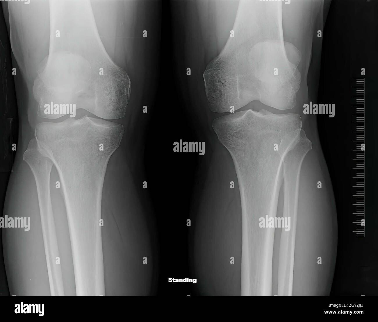 X-ray film of healthy male knees Stock Photo - Alamy