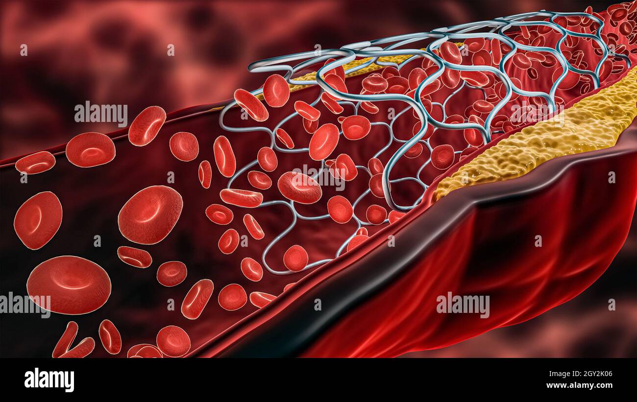 Angioplasty 3D rendering illustration. Deployed Stent within a diseased ...