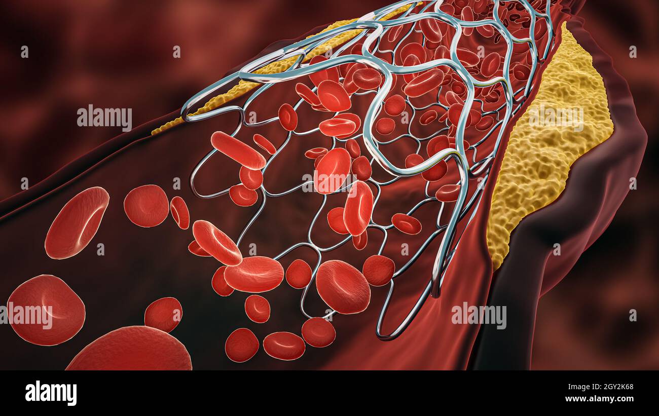 Angioplasty 3D rendering illustration. Deployed Stent within a diseased ...