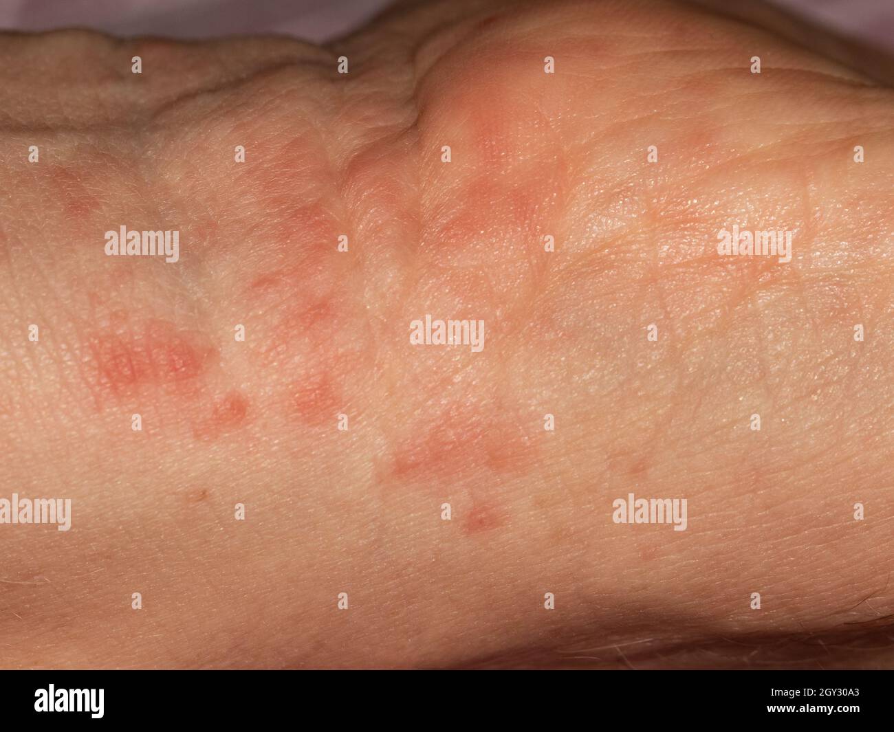 Scarlet fever rash hi-res stock photography and images - Alamy