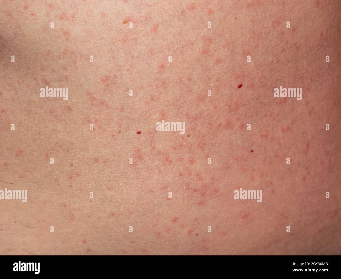 Scarlet fever quarantine hi-res stock photography and images - Alamy