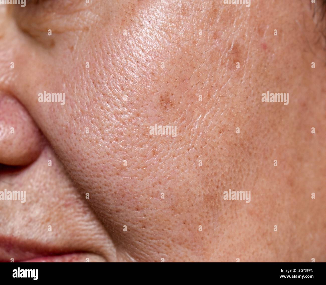 Large Pores On Cheeks
