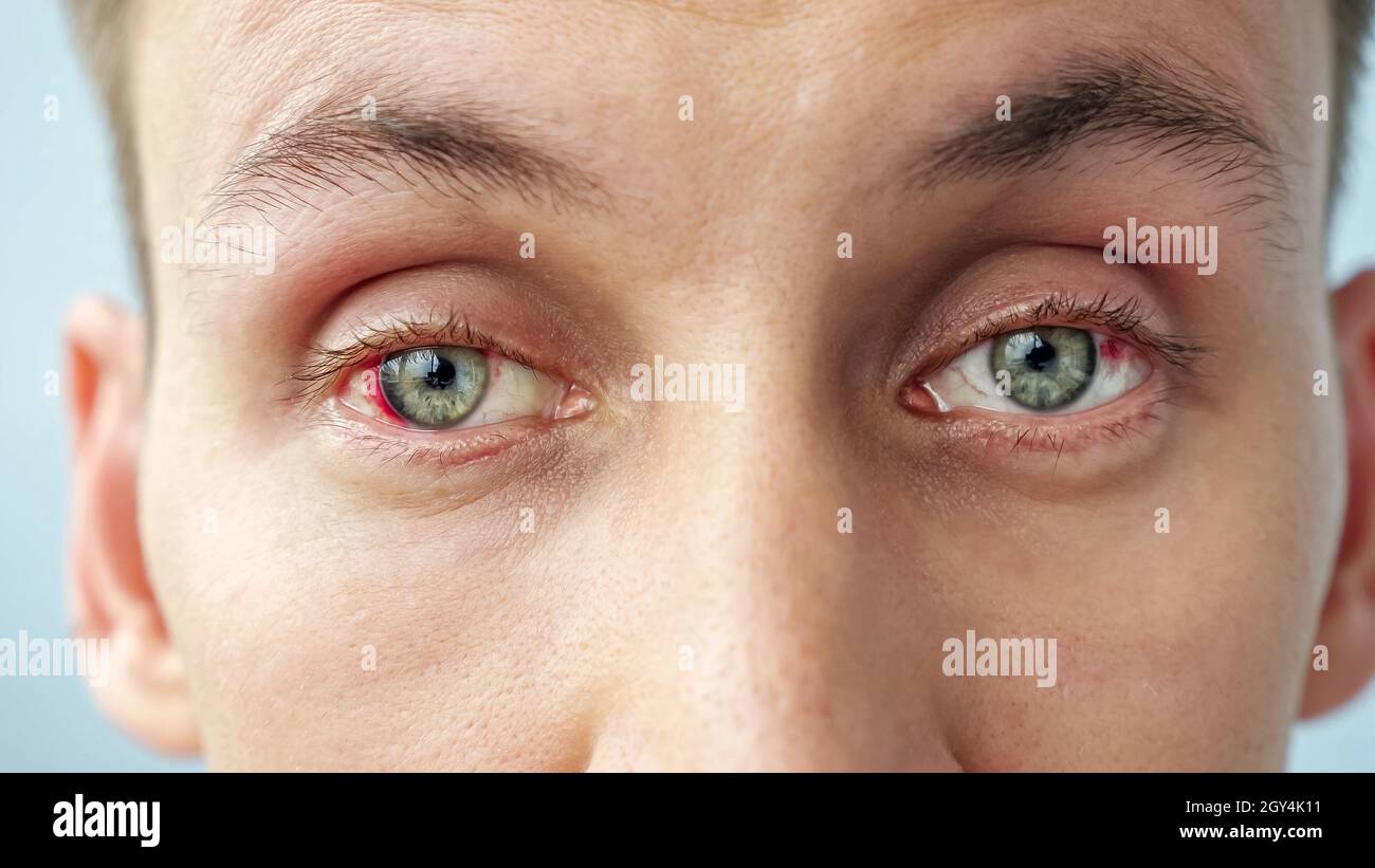 Man red eyes irritation hi-res stock photography and images - Alamy