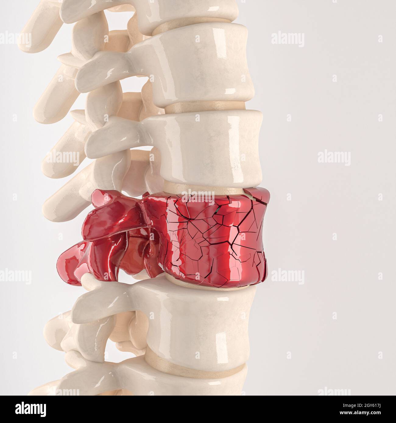 spine with shattered vertebrae. concept of physical discomfort. 3d ...