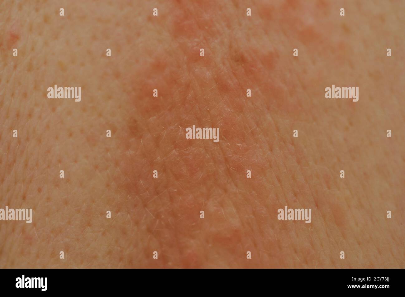 Eczema pimples on a back Stock Photo - Alamy