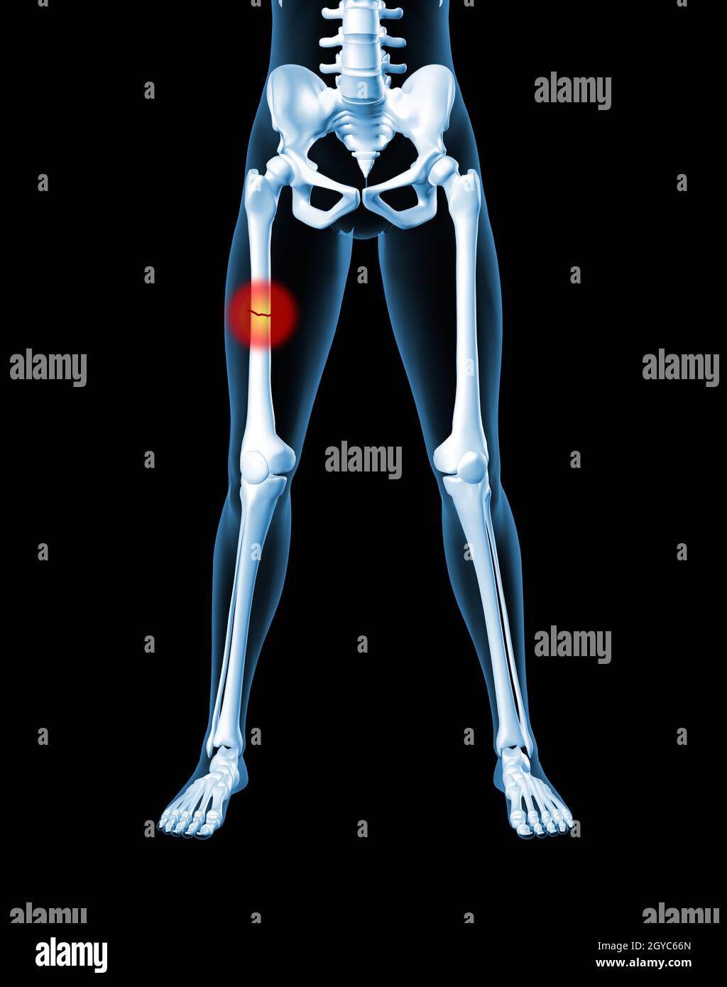 3D render of a medical female skeleton with a broken leg bone ...