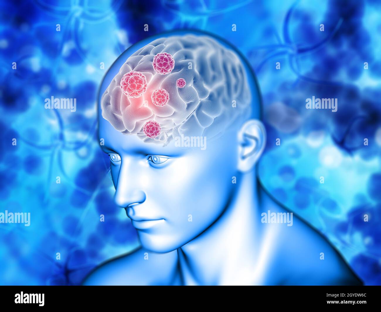 3D render of a medical background with virus cells on brain highlighted ...