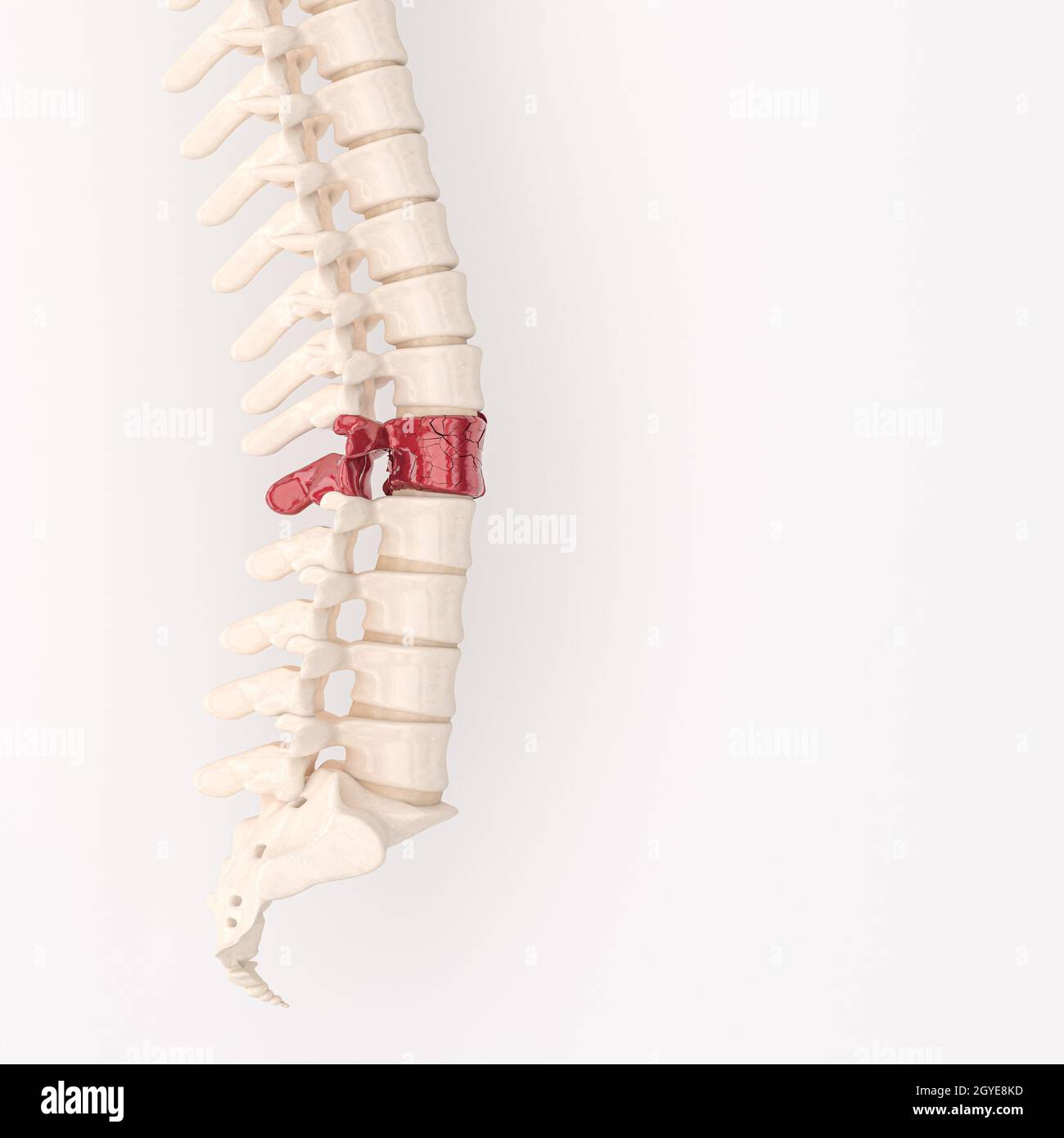 backbone with red fragmented vertebrae. back problem concept. 3d render ...