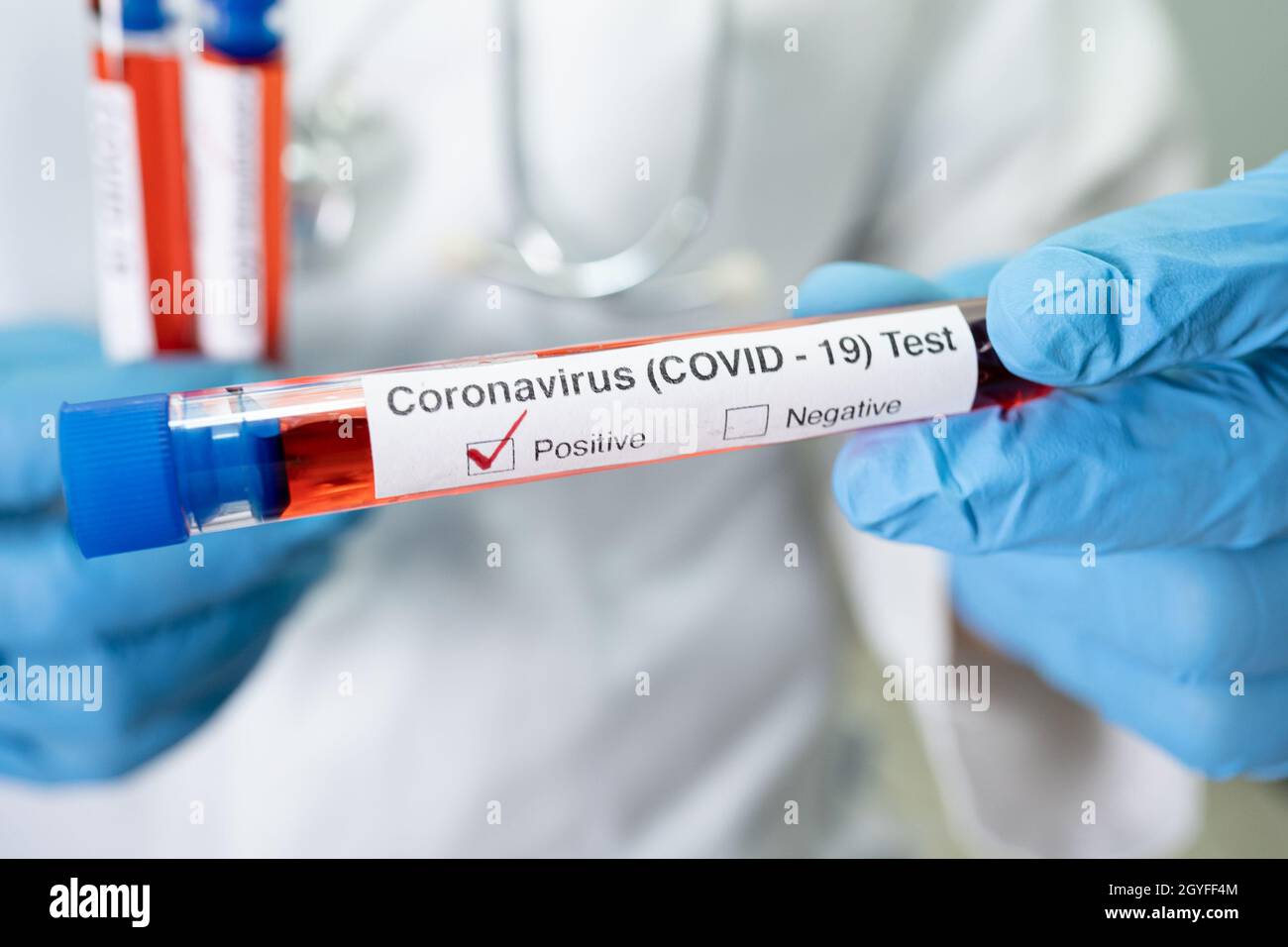 Positive blood infection sample in test tube for covid-19 coronavirus ...