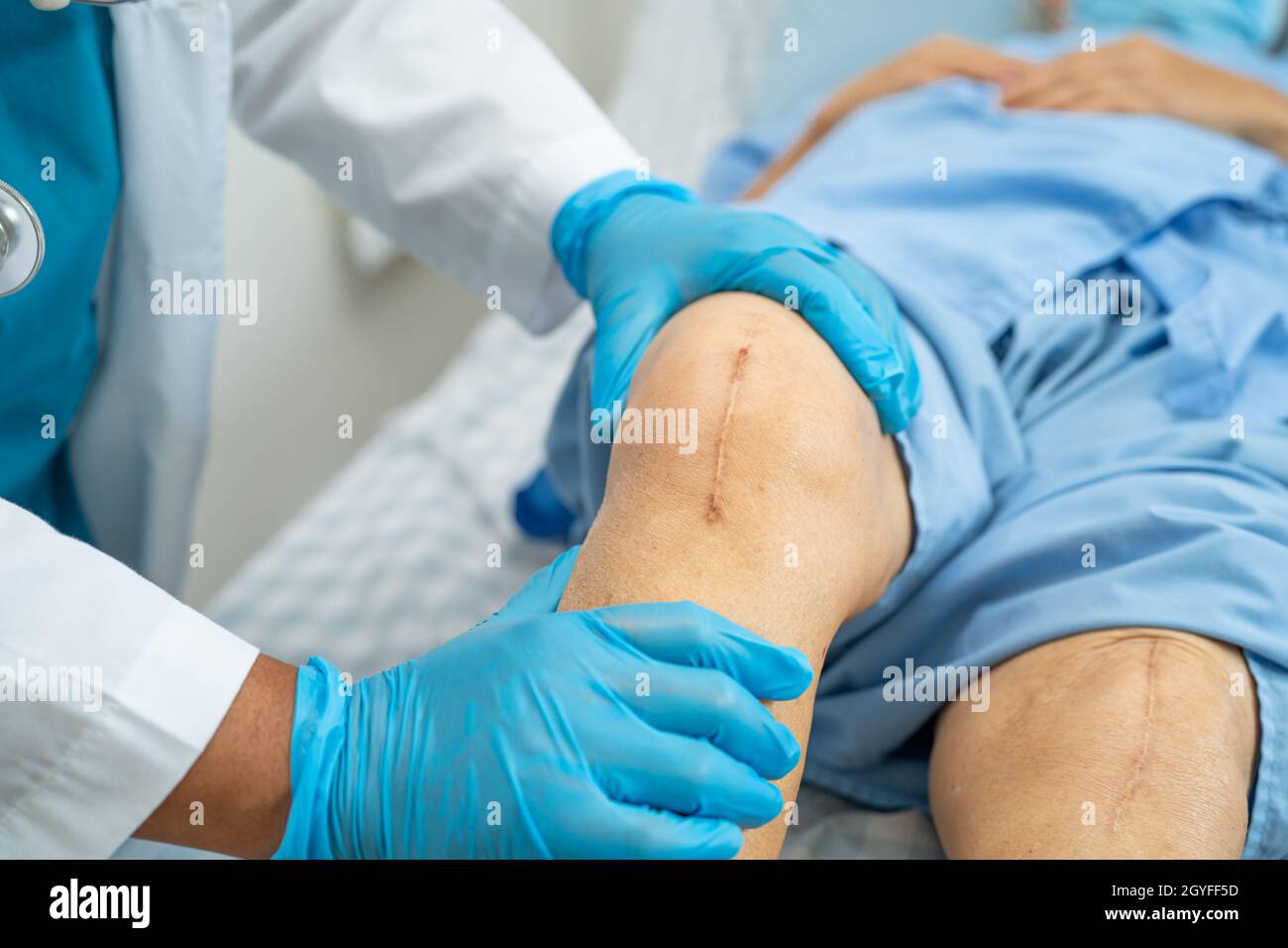 Asian senior or elderly old lady woman patient show her scars surgical ...