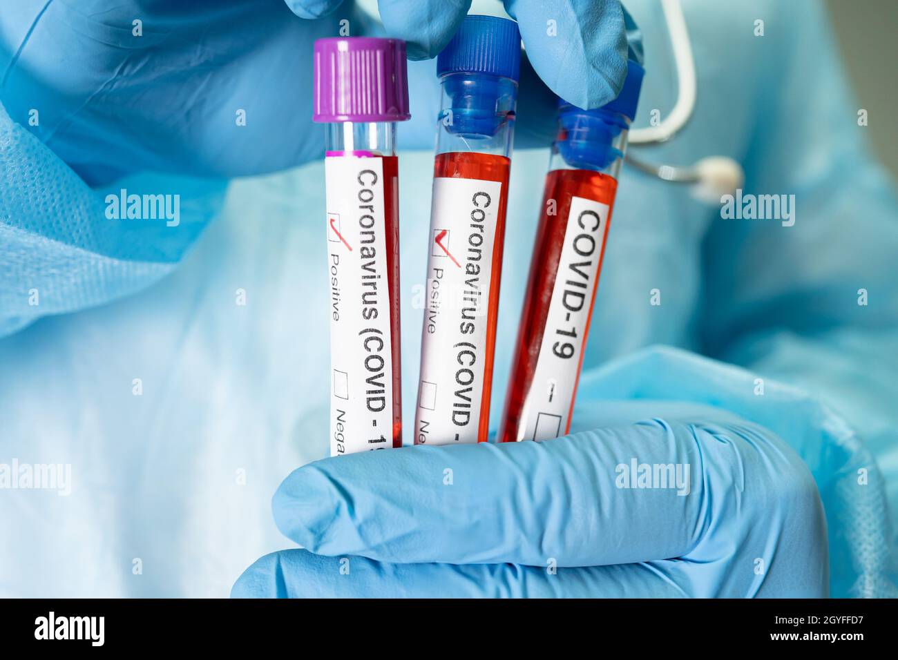 Positive blood infection sample in test tube for covid-19 coronavirus ...