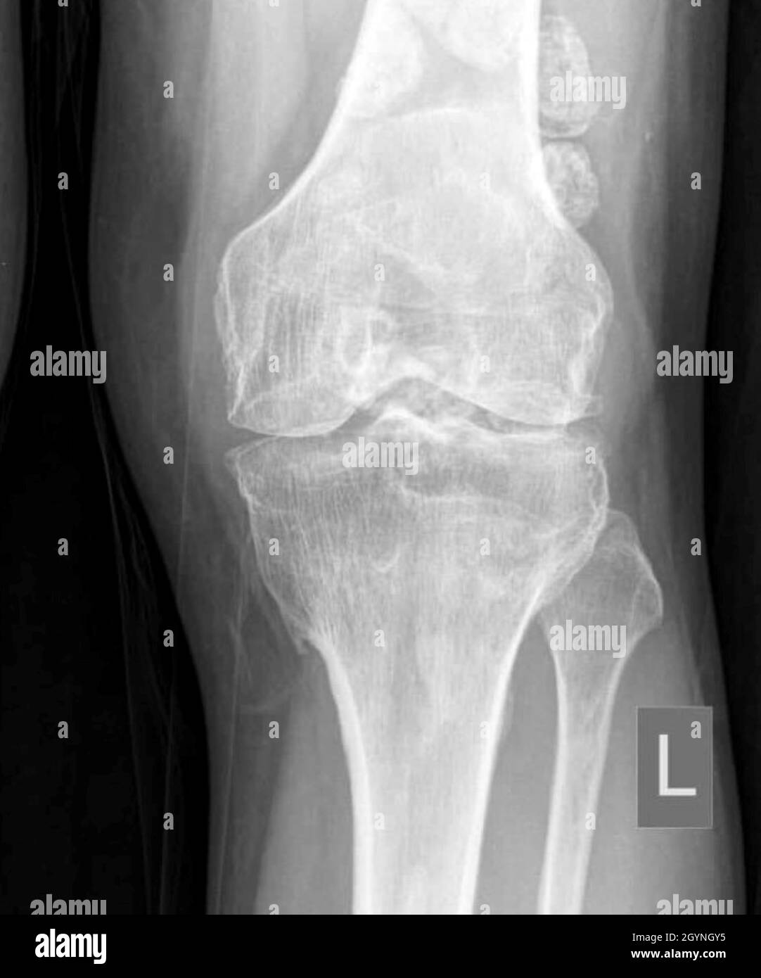 Synovial chondromatosis, X-ray Stock Photo - Alamy