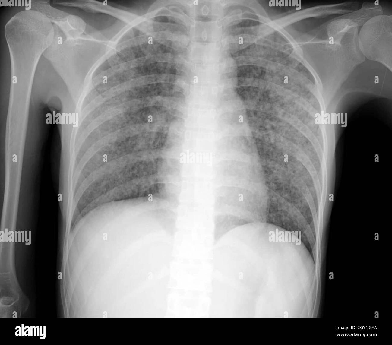 Abnormal chest xray Black and White Stock Photos & Images - Alamy