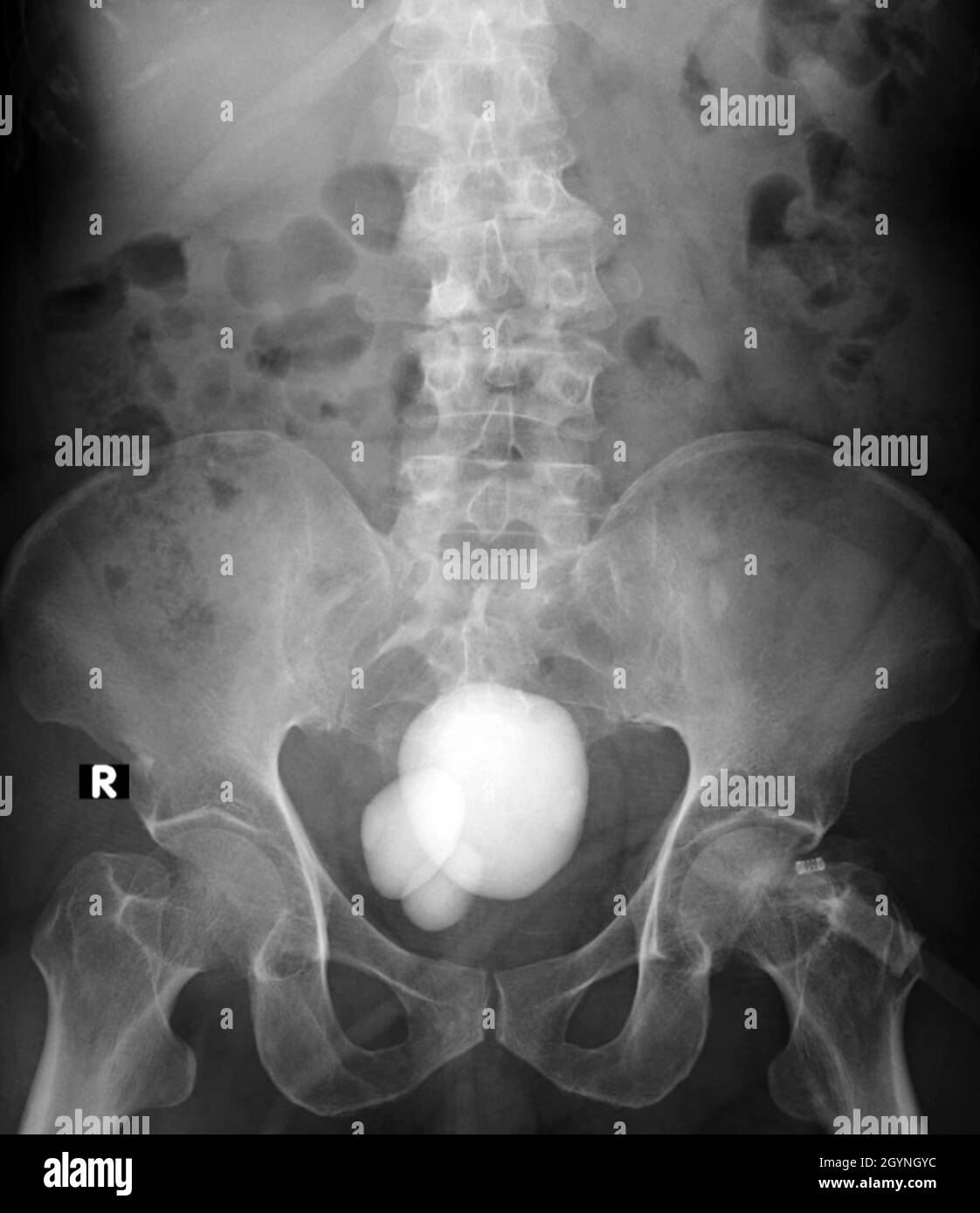 Bladder stones hi-res stock photography and images - Alamy