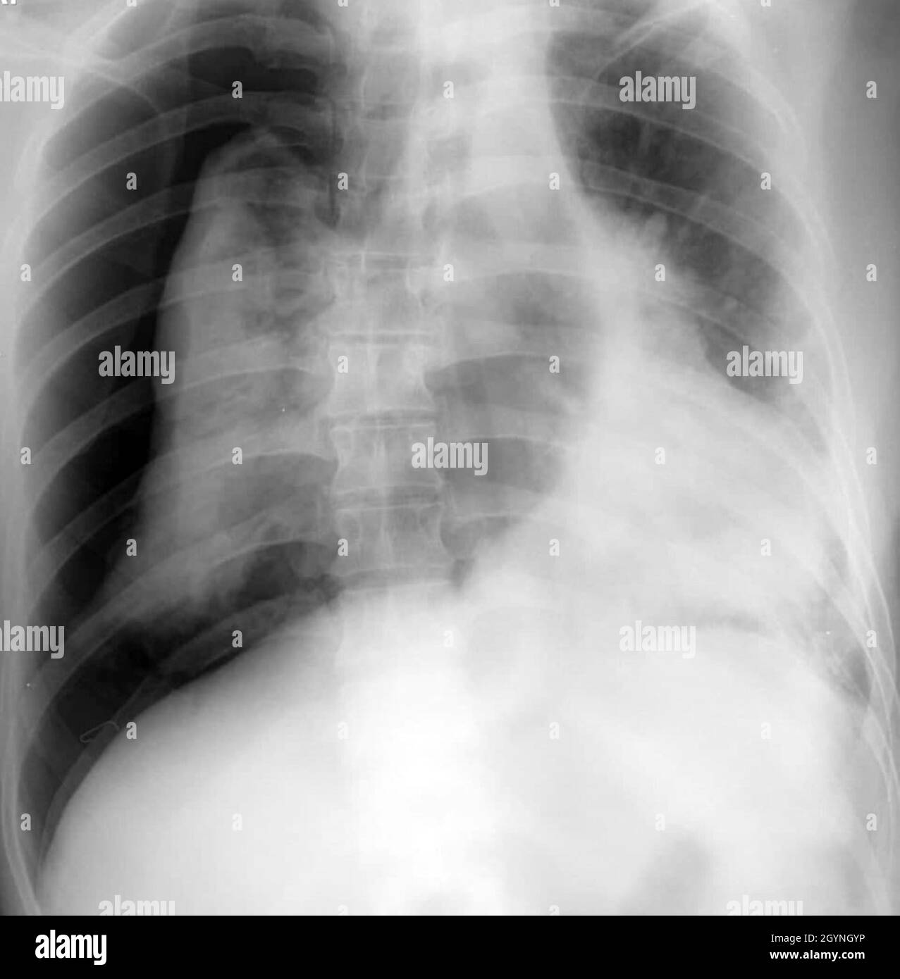 X Ray Images Of Pneumothorax