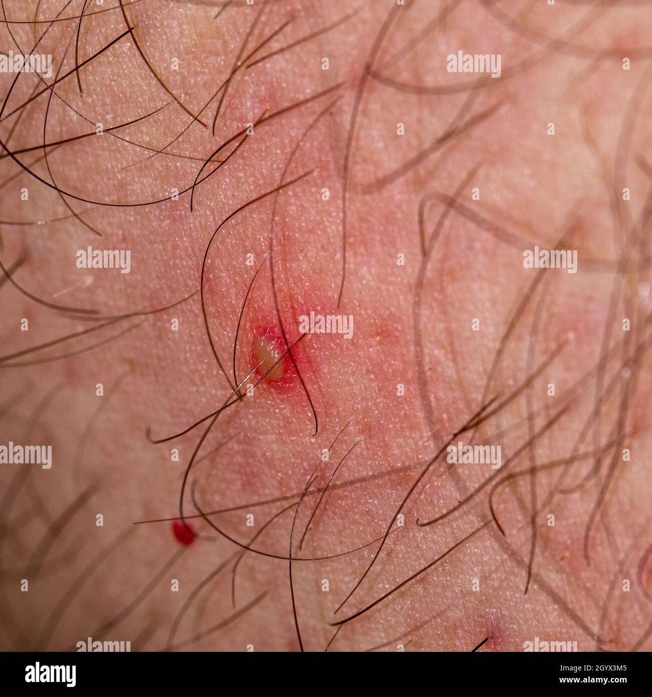 Skin pustule hi-res stock photography and images - Alamy
