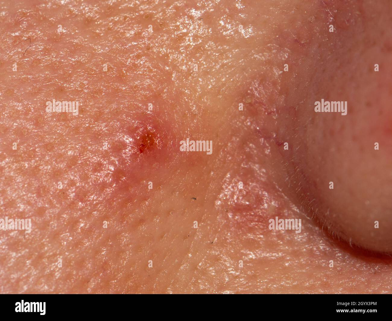 detail of a small inflamed pustule on the skin of a Caucasian person ...