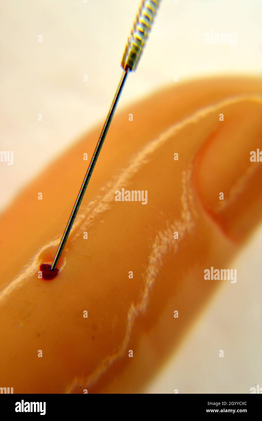 acupuncture demonstration on hand model Stock Photo - Alamy