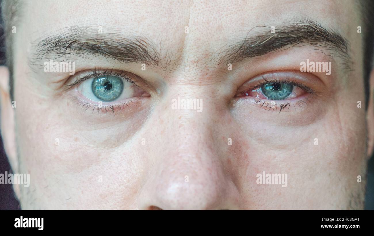 Close Up of Severe Bloodshot Red Blood Eye of Male Affected by ...
