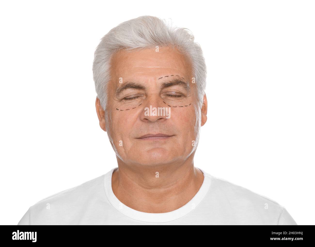 Man face surgery marks hi-res stock photography and images - Alamy