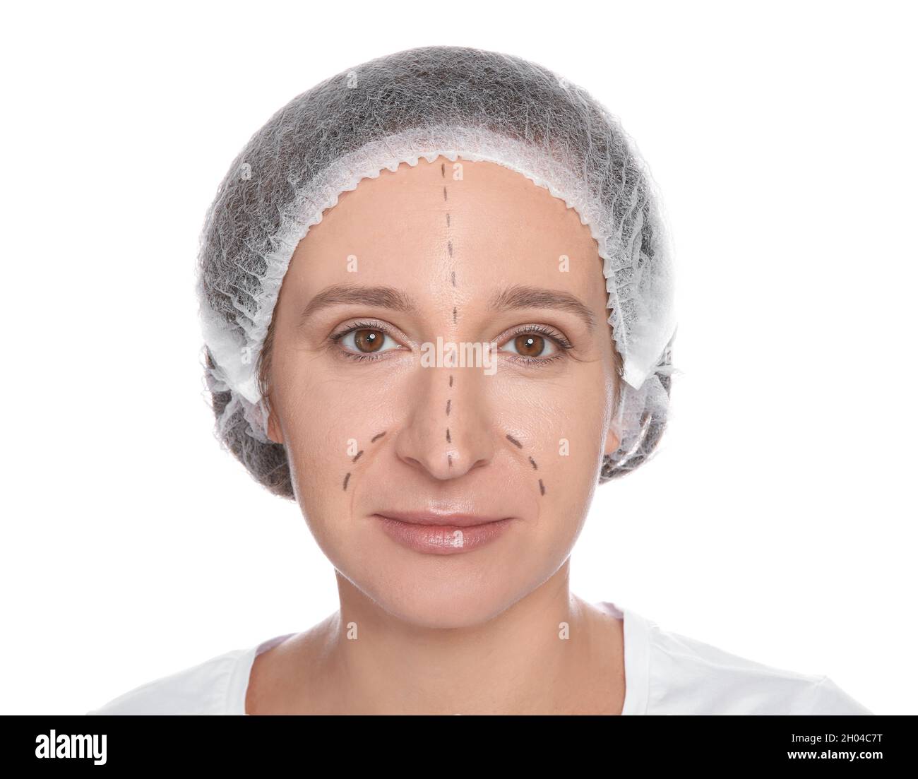 Portrait of woman with marks on face preparing for cosmetic surgery ...