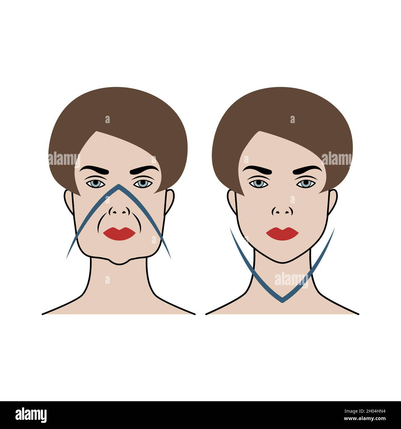 Lifting of female face. Comparison of woman before and after. Facial ...