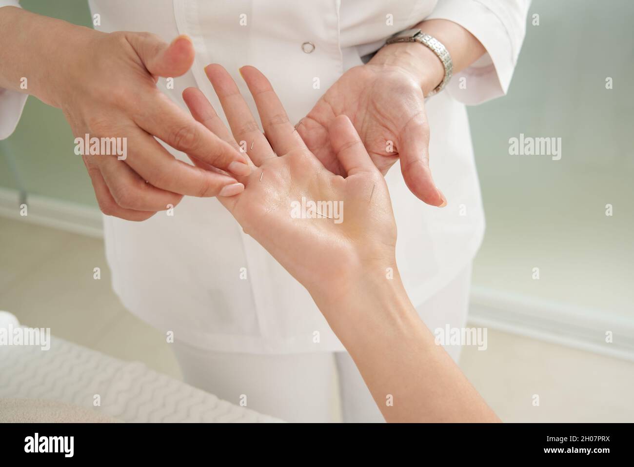 Young woman having an acupuncture treatment therapy on hand in spa ...
