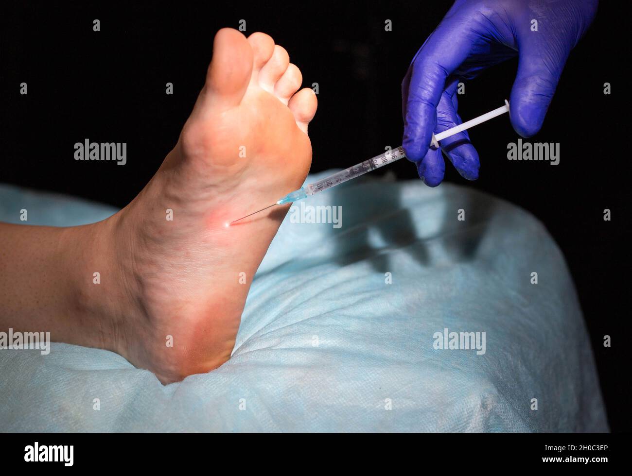 An injection against hyperhidrosis sweating in the foot of the soles of ...