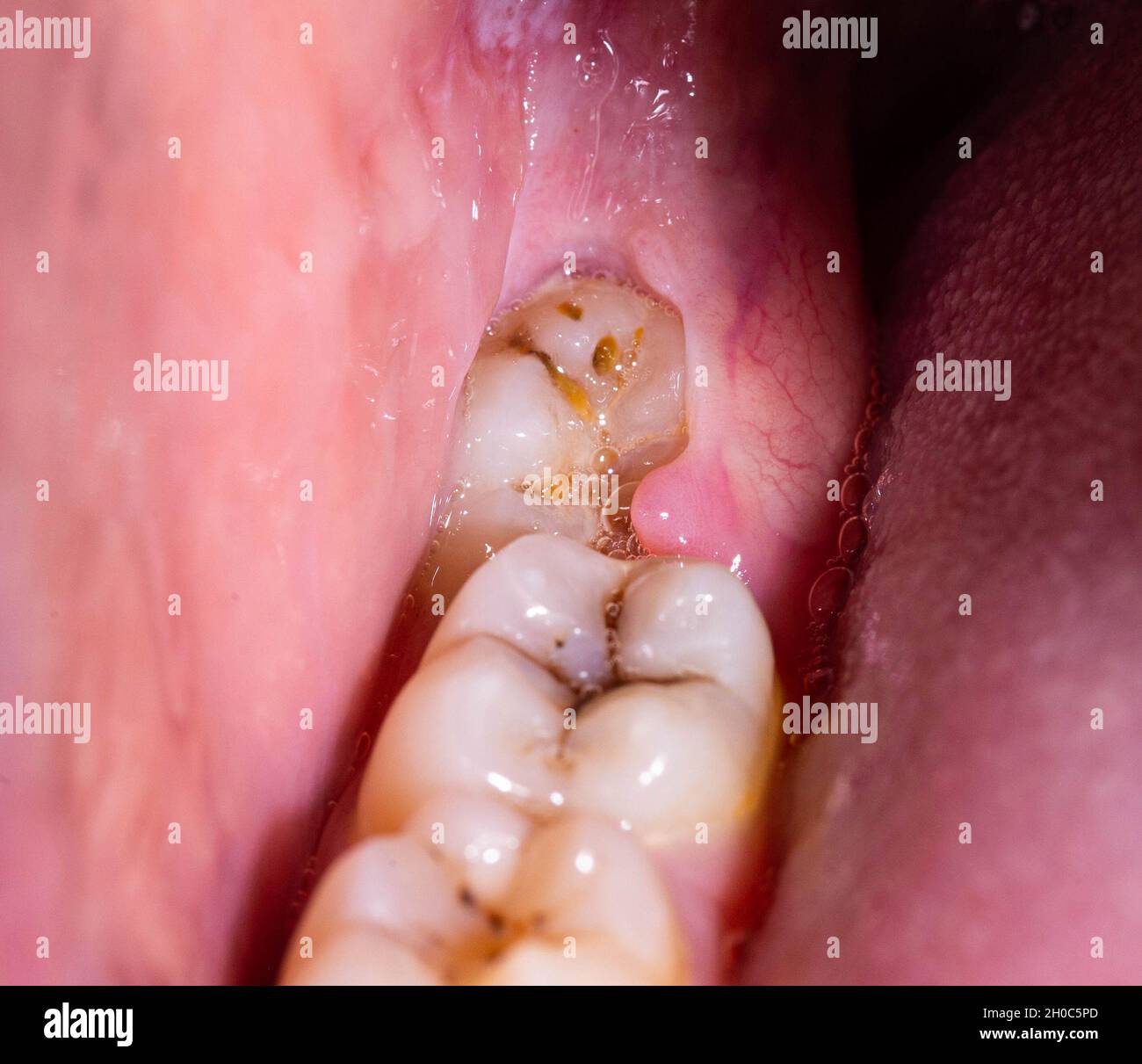 Unerupted wisdom tooth hi-res stock photography and images - Alamy