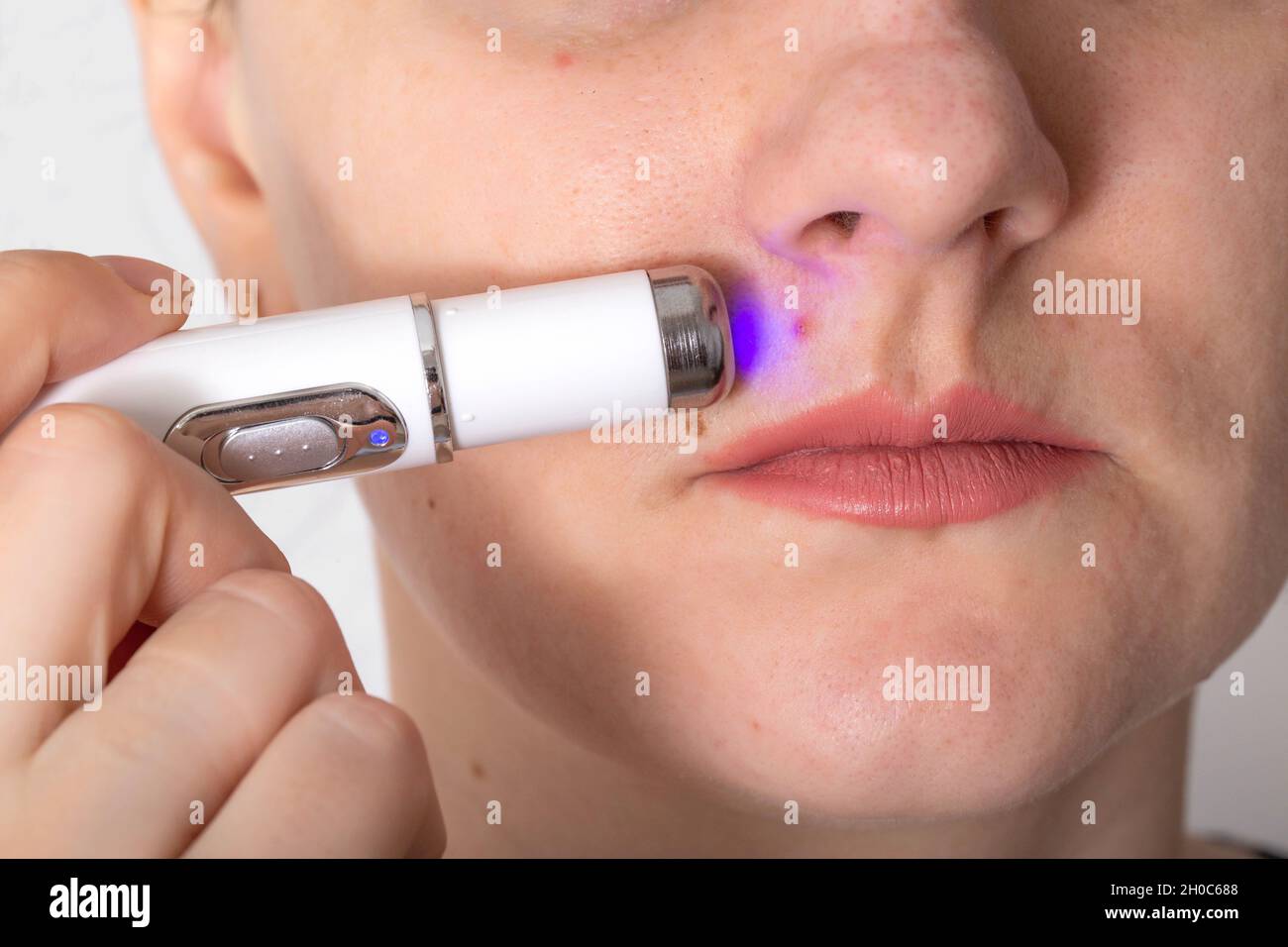Girl treats inflamed red acne on the skin of the face with a laser ...