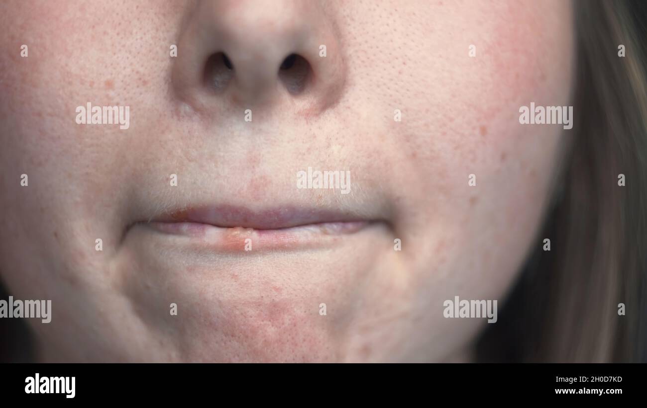 Close-up of female problem skin with herpes on lips. Media. Well ...