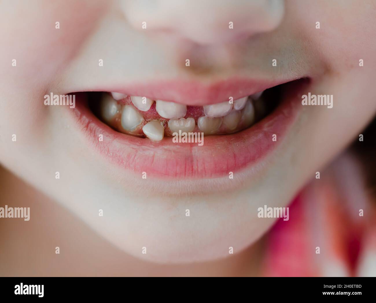 Girl with loose tooth hi-res stock photography and images - Alamy