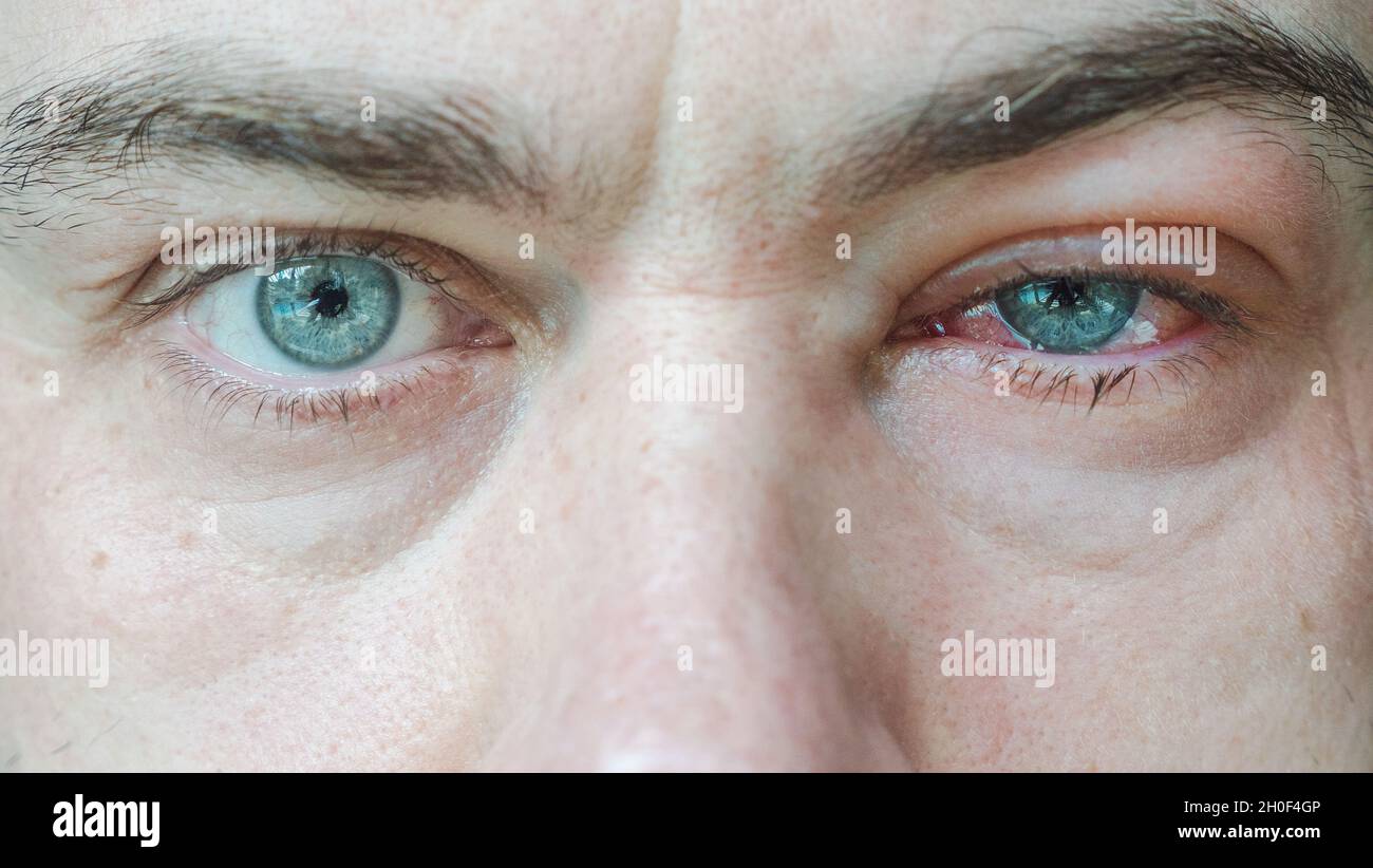 Bacterial conjunctivitis male hi-res stock photography and images - Alamy
