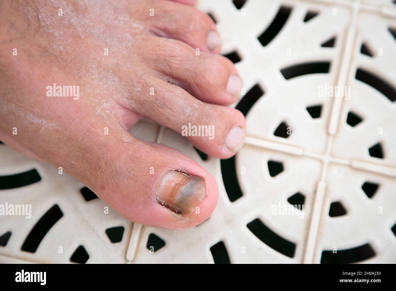 Details of man nails with fungal infection known as mycosis, natural ...