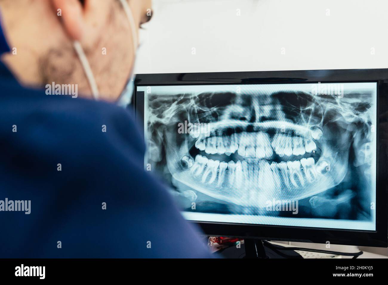 Medical dentist examining a panoramic x-ray on a computer screen in a ...