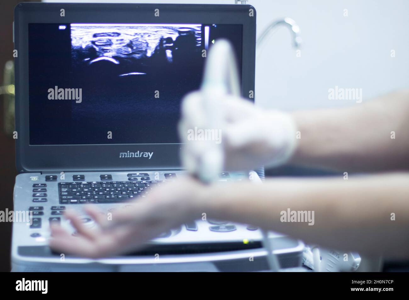 EPI Intratissue Percutaneous Electrolysis dry needling ultrasound ...