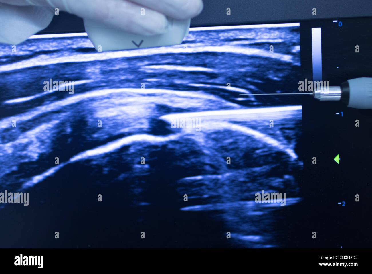 EPI Intratissue Percutaneous Electrolysis dry needling ultrasound ...