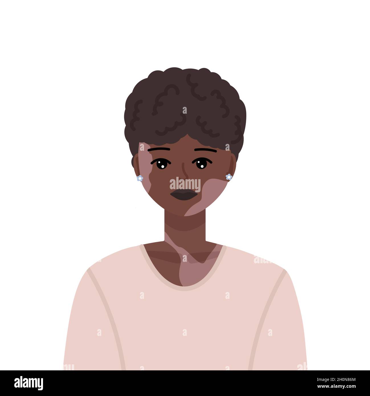 Vector illustration of young and beautiful black woman with vitiligo ...
