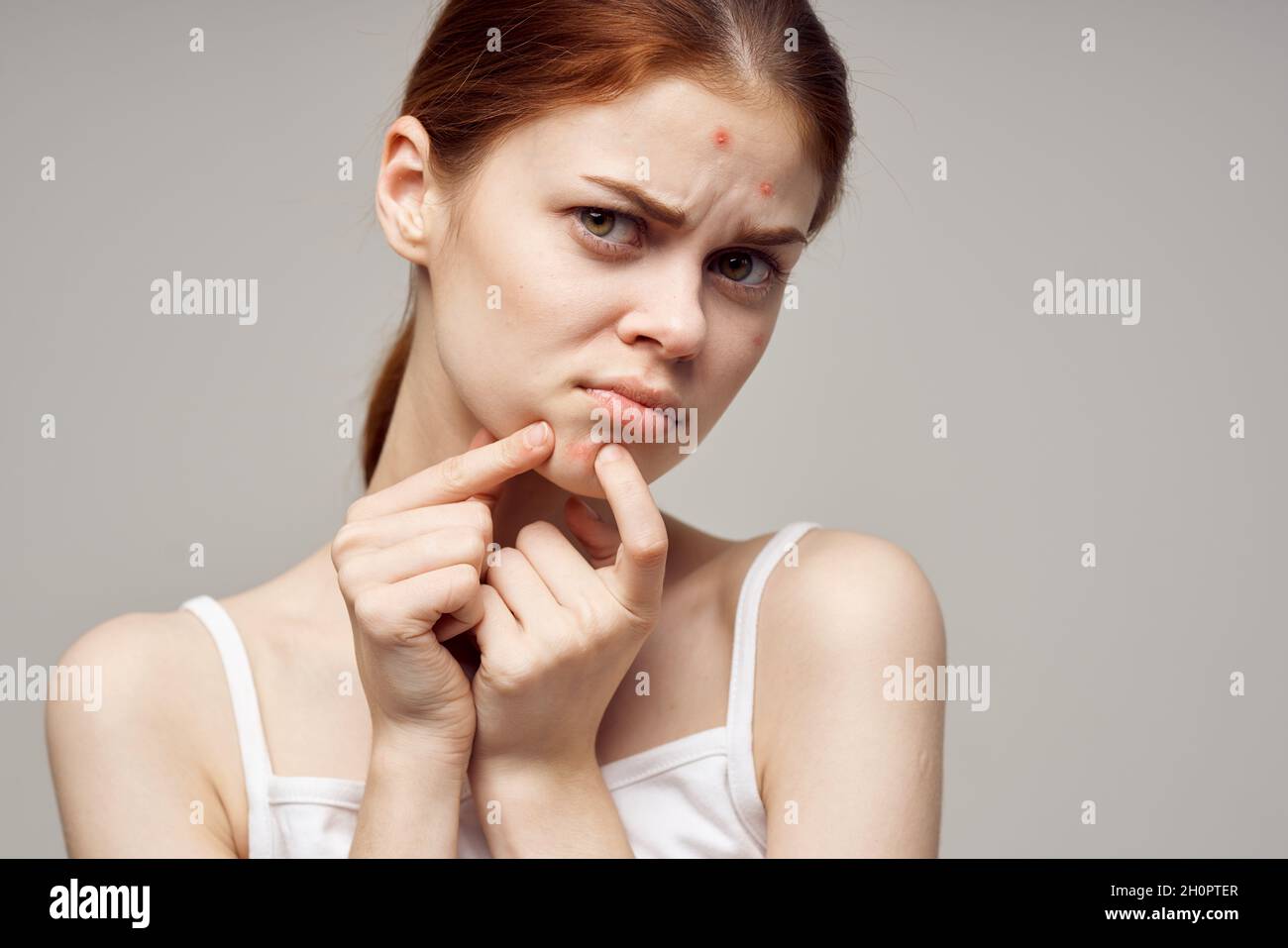 pretty woman with pimples on the face hygiene light background Stock ...