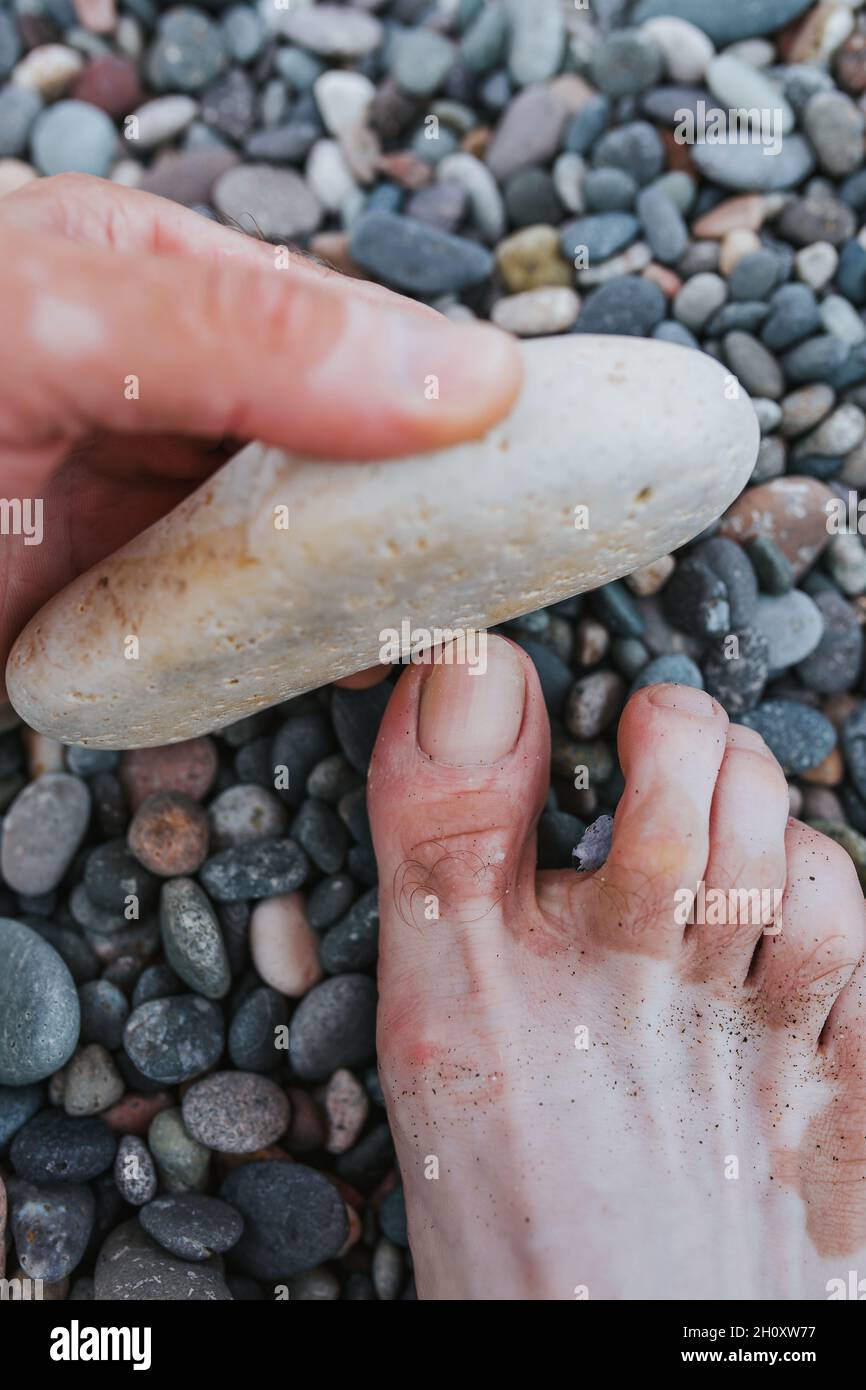 Man grinding his thumbnail with a stone - broken, unkempt nail ...