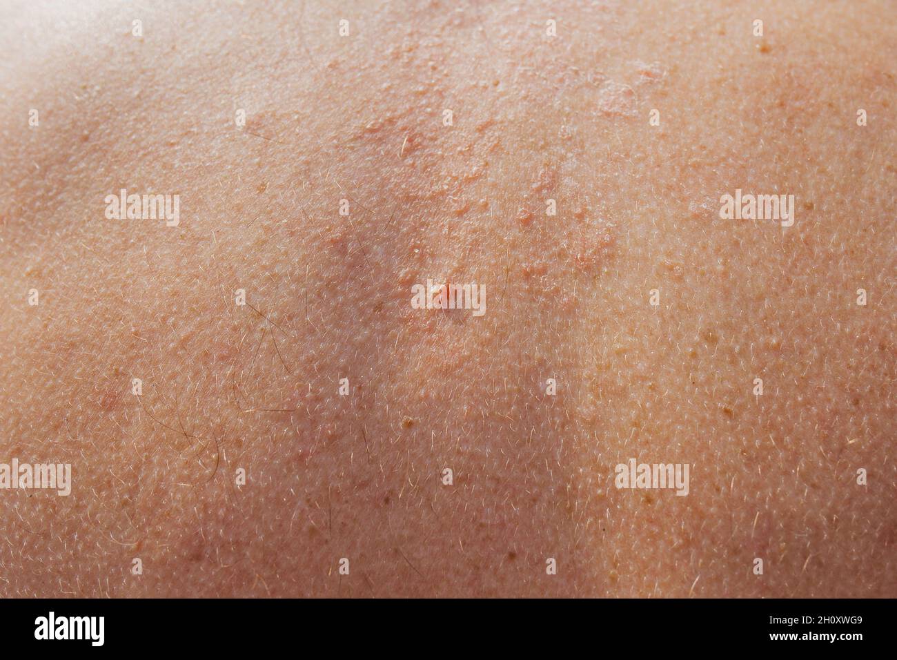 Seborrhea on the skin of the back - skin conditions treatment at a ...