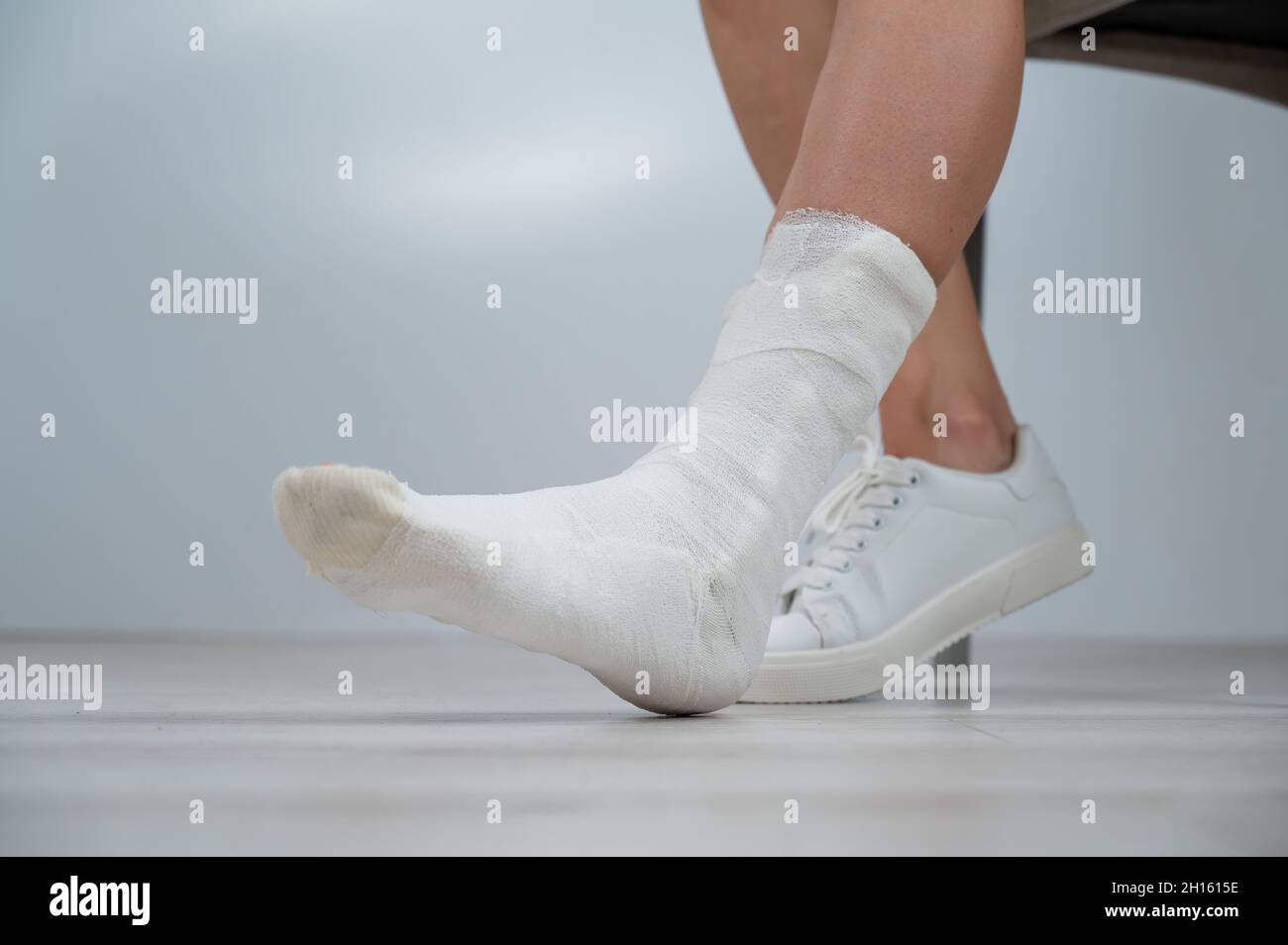 Close-up of female legs with plaster cast. A woman with a broken leg ...