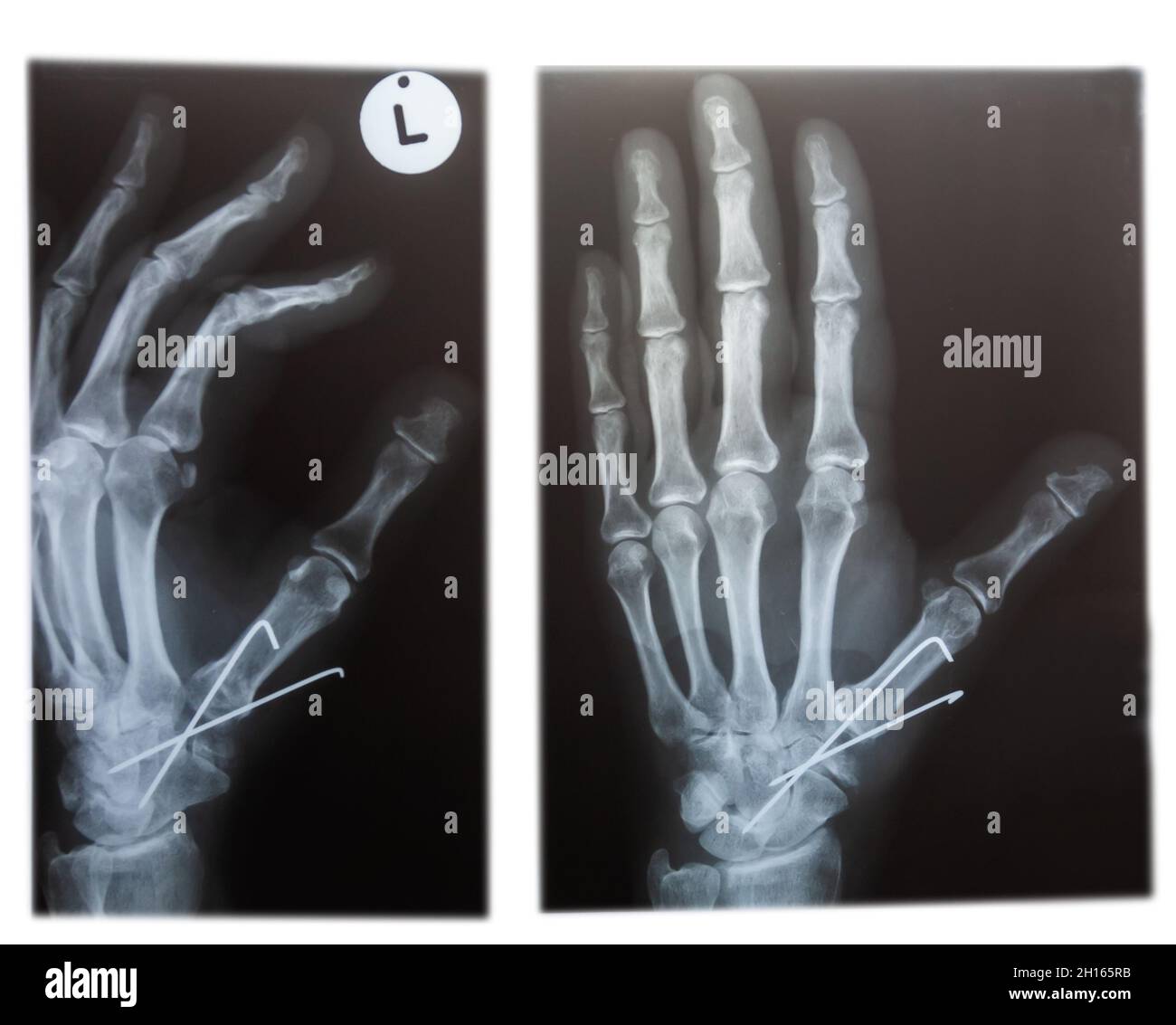 woman with broken hands radiography Stock Photo - Alamy