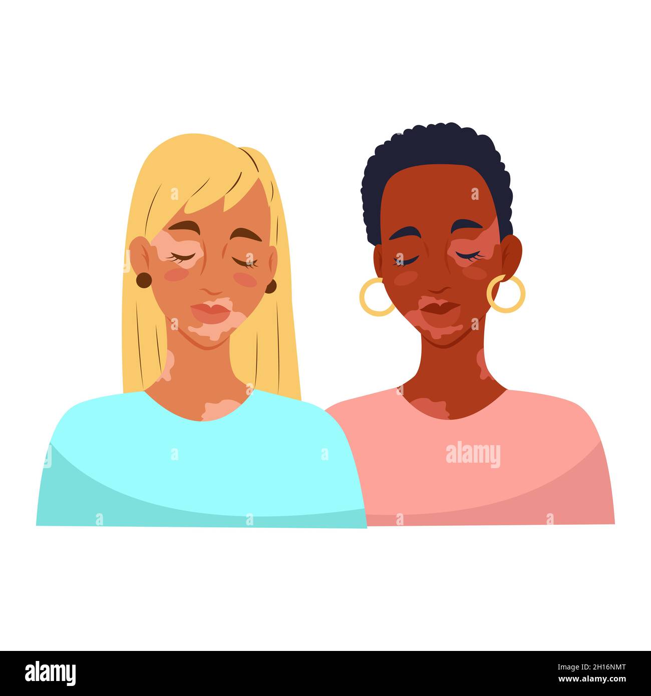 Two women with vitiligo. Vitiligo skin disease. Vector illustration ...
