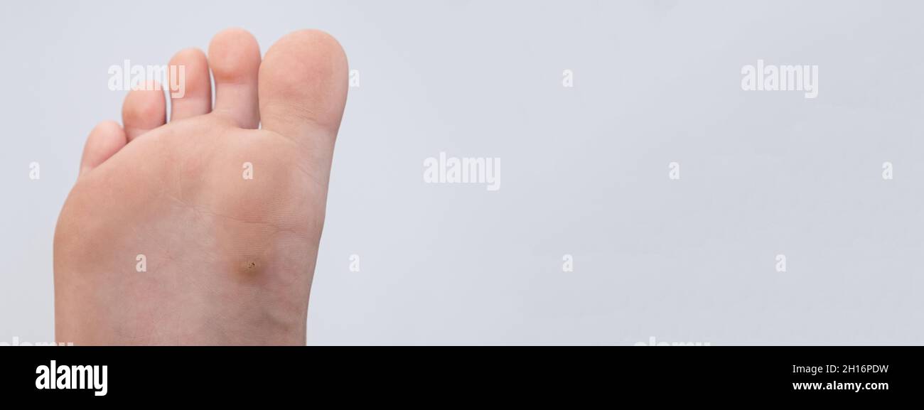 wart, papilloma on a feet. Macro shot, selective focus, close-up, space ...