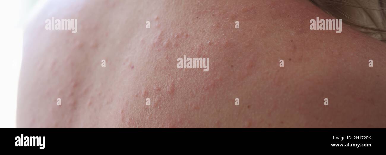 Woman injured back with rash and red sun spots Stock Photo - Alamy