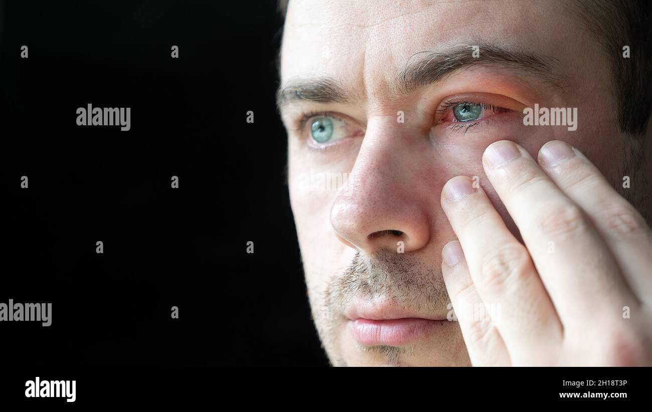 Sad Man Touch His Severe Bloodshot Red Blood Eye Affected by ...