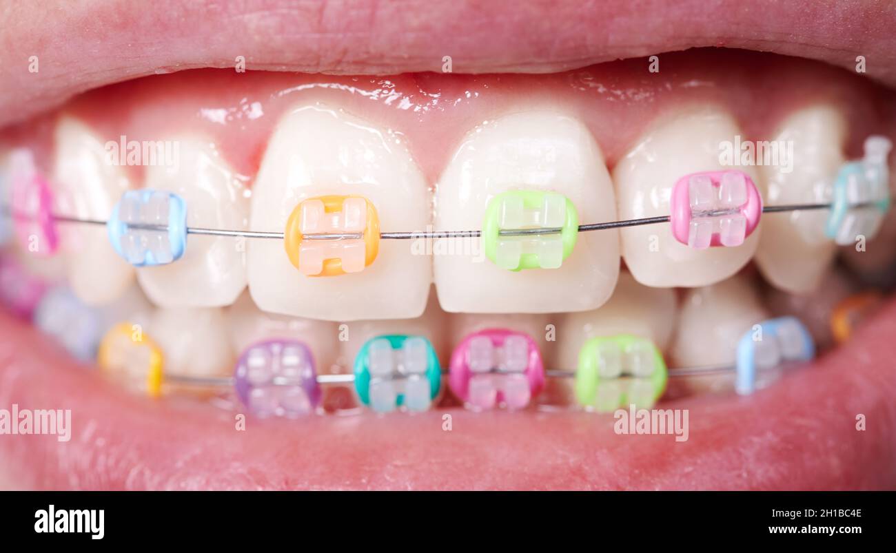 White Bracket Braces