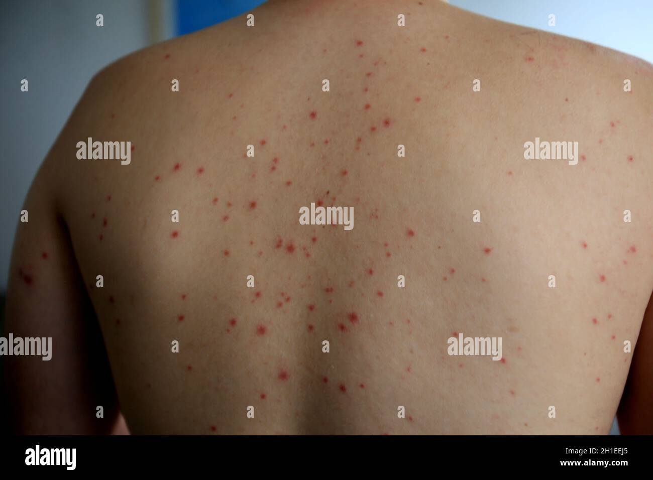 Rubella Rash Adult
